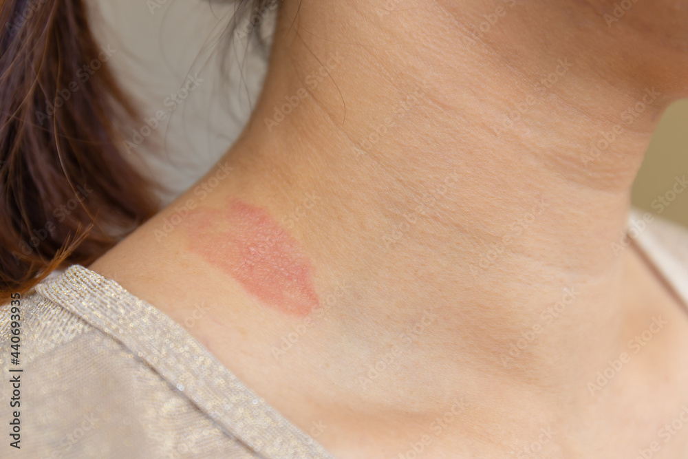 Foto de Stock ill allergic rash dermatitis eczema skin texture, Red ...