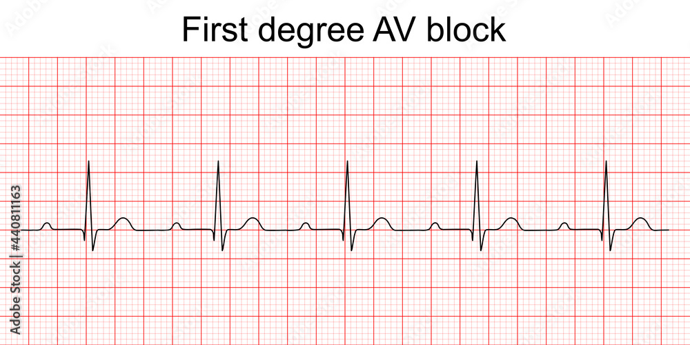 Electrocardiogram show first degree AV block pattern. ECG. EKG. Vital ...