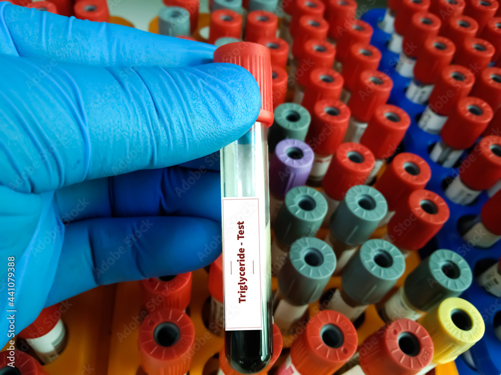 Blood sample tube holding by doctor for Cardiac marker, lipid profile ...
