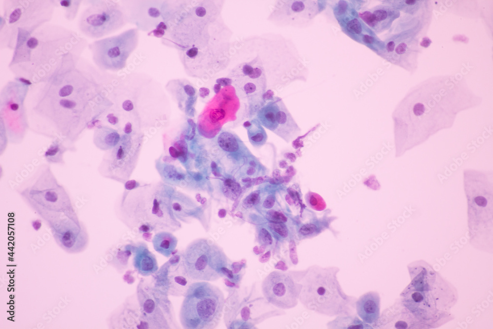 View in microscopic of Abnormal human cervix cells.Squamous epithelium ...