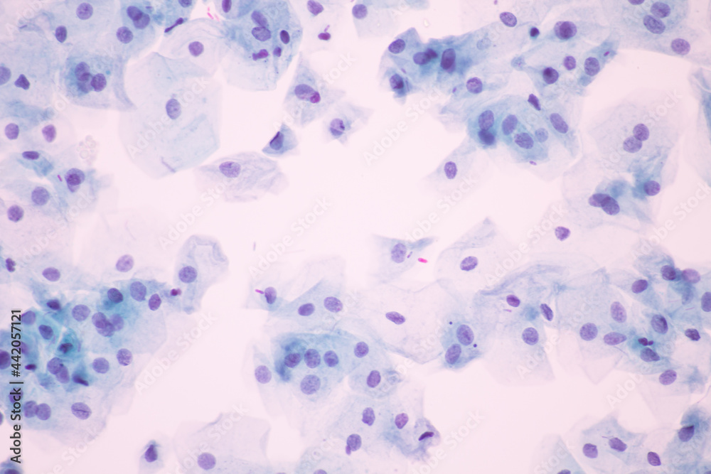 View in microscopic of Abnormal human cervix cells.Squamous epithelium ...