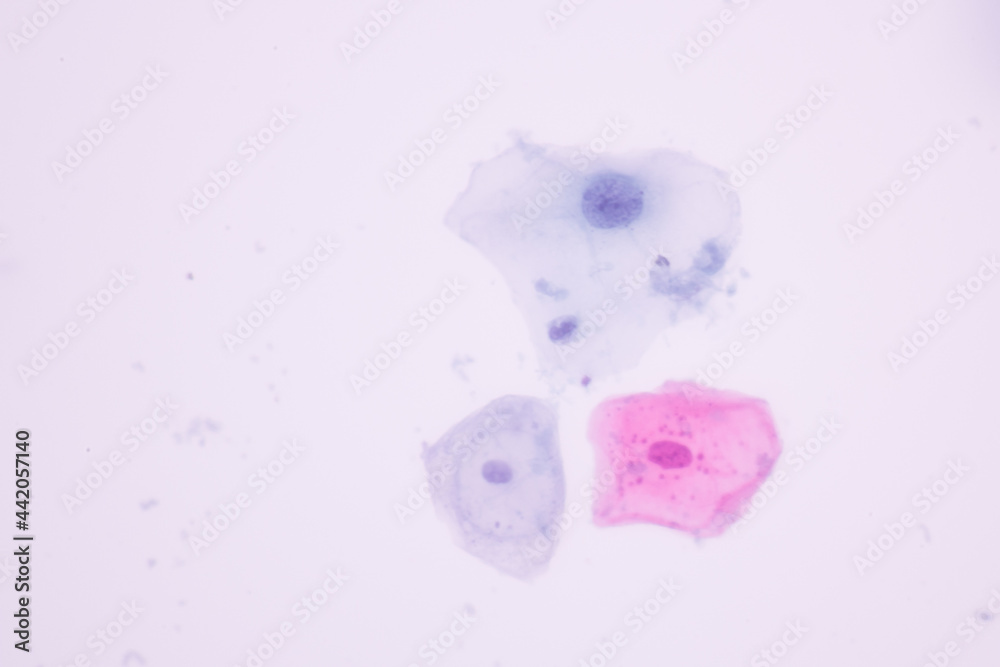 View in microscopic of Abnormal human cervix cells.Squamous epithelium ...