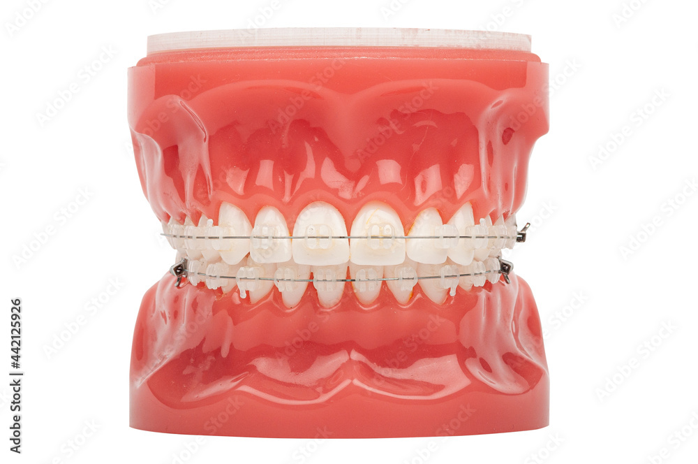 Orthodontic model demonstration teeth model of orthodontic bracket or ...
