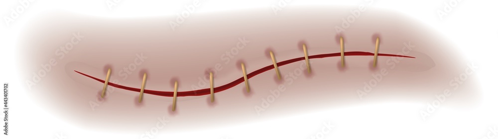 Scar or wound. Realistic bloody stitch. Surgical sutures healing seam ...