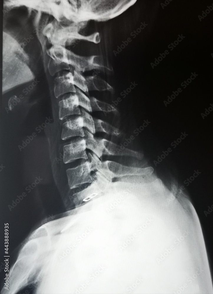 X-ray of neck and spine Stock Photo | Adobe Stock