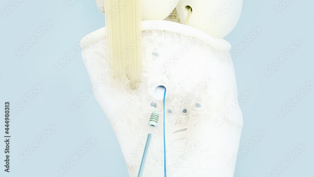 Knee surgery, torn tendon repair, ligament repair, pins, bone drilling ...