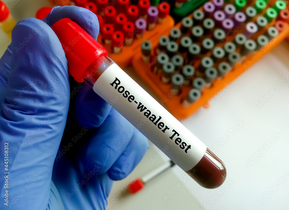 Foto de Stock Rose waaler test is a haemagglutination slide test for ...