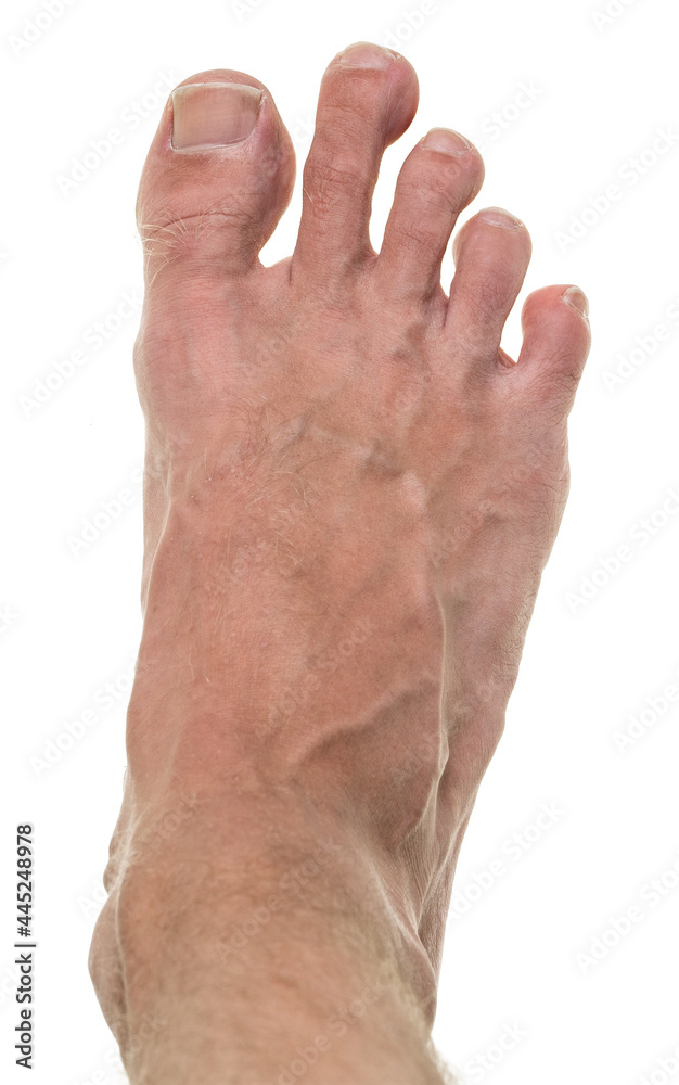 medical top view photo of right male foot where the second toe is ...