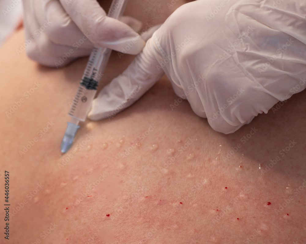 Lipotropic injections close up. Woman Belly fat dissolving treatment ...