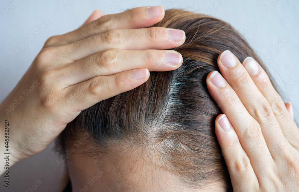 Cropped view of Asian woman forehead with part of her thin hair, she ...