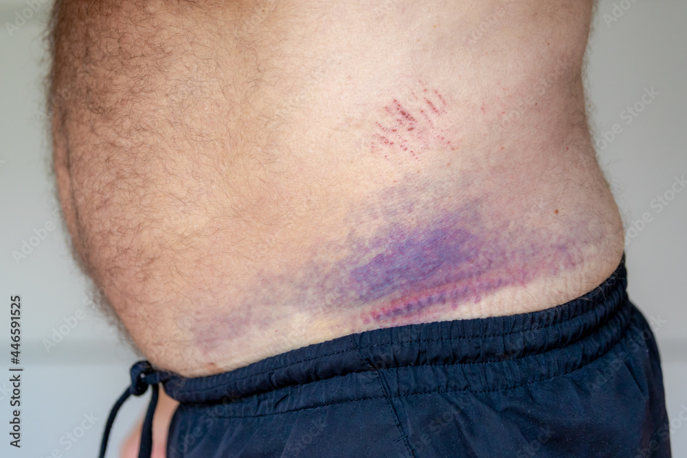 Photo Stock Selective focus of a man rib with blue and scratch on skin ...
