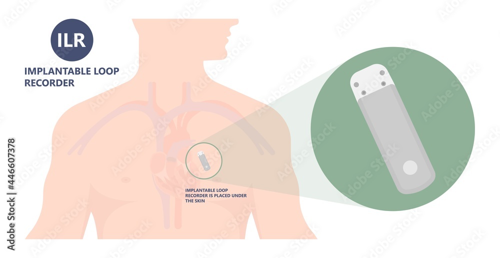 loop holter event atrial heart attack stroke ECG EKG device monitoring ...