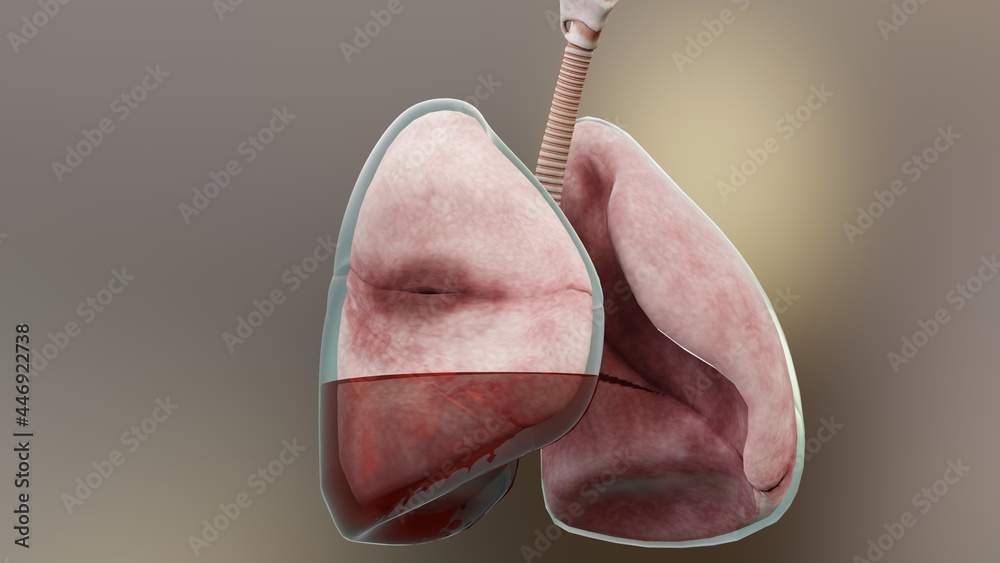 3d Illustration of Hemopneumothorax, Normal lung versus collapsed ...