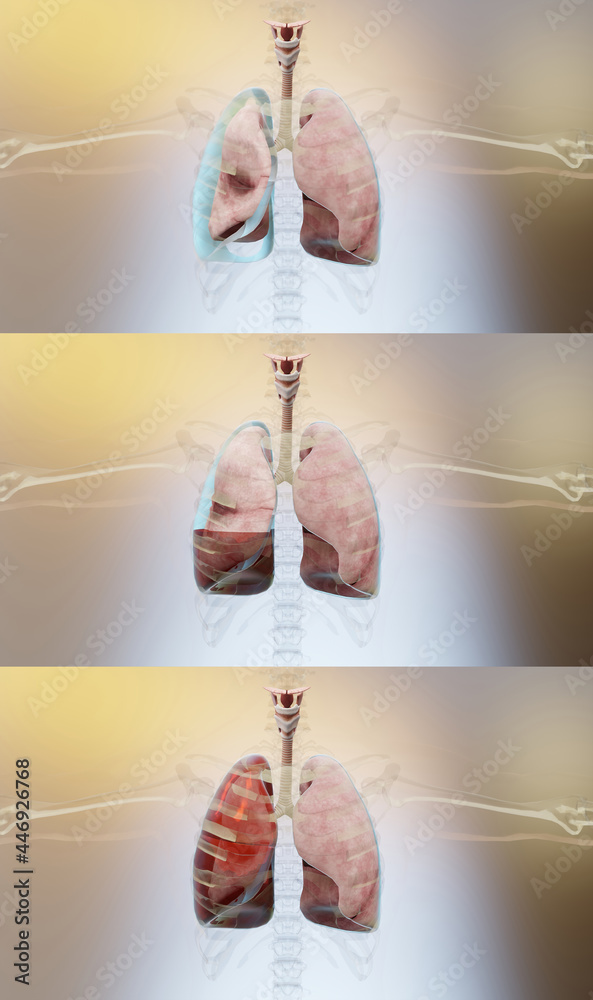 3d Illustration of Pneumothorax, Hemothorax and Hemopneumothorax ...