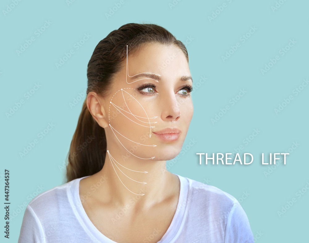 thread lift procedure ,non-surgical facelift,markup Stock Photo | Adobe ...