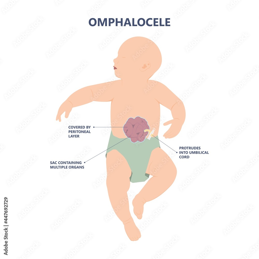Gastroschisis Omphalocele usmle hernia birth defect silo wall fetus ...