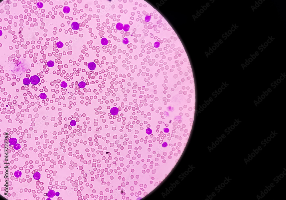 Acute lymphocytic leukemia (ALL) is a type of blood cancer, Microscopic ...
