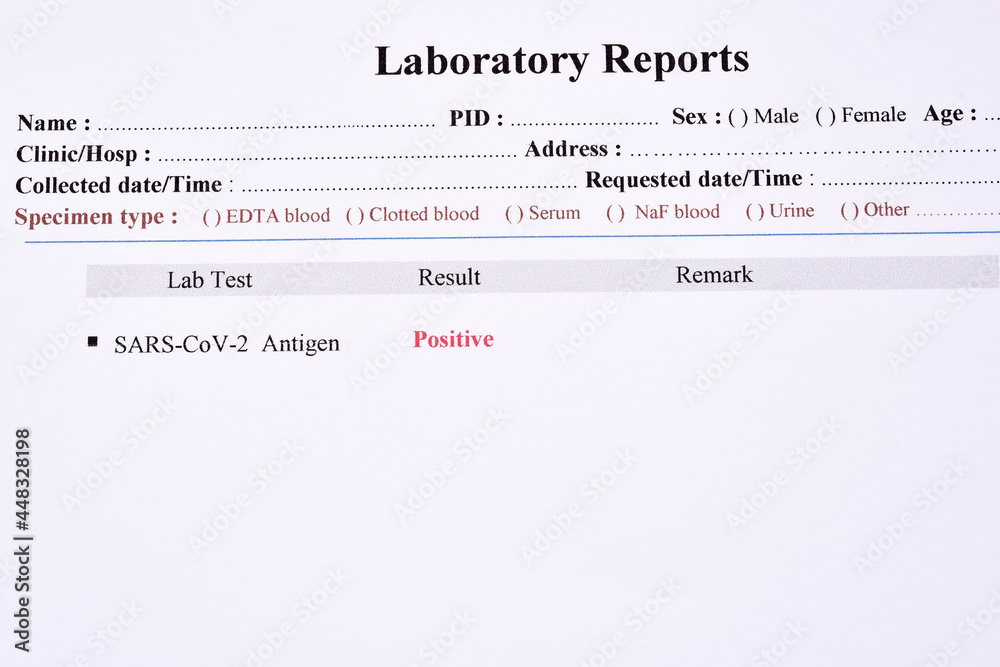 COVID-19 positive test result by using COVID-19 antigen test kit, rapid ...
