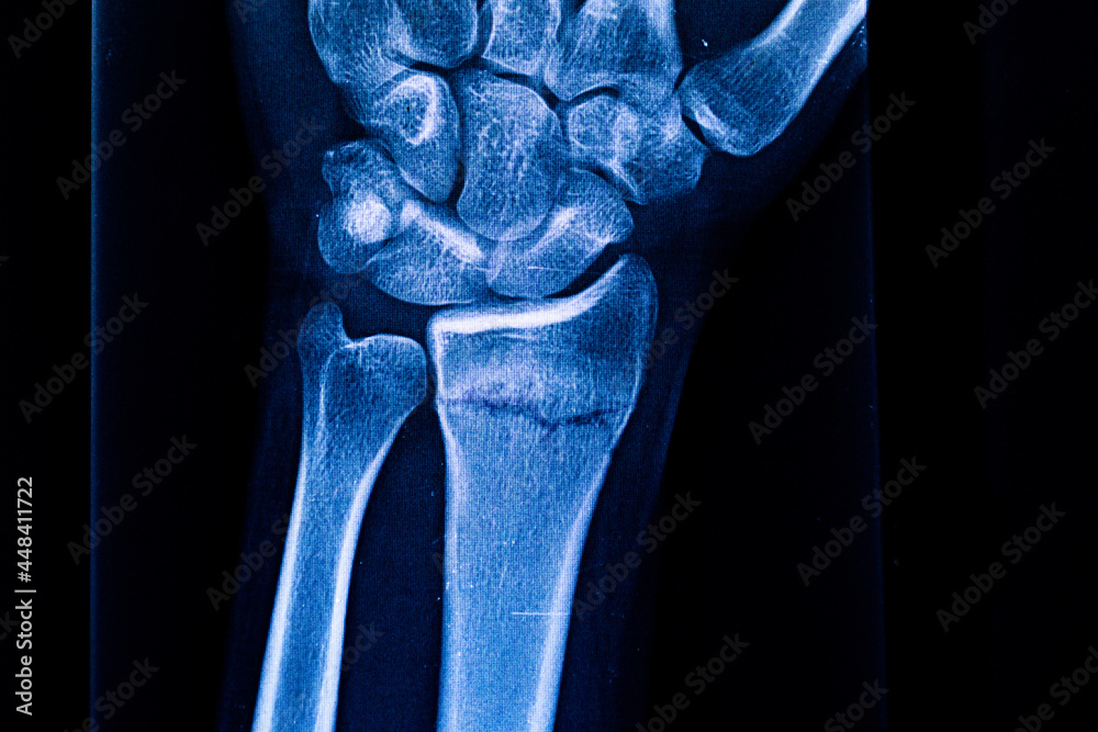 Radiography examination of radius fracture. X-ray human arm. X-ray of ...