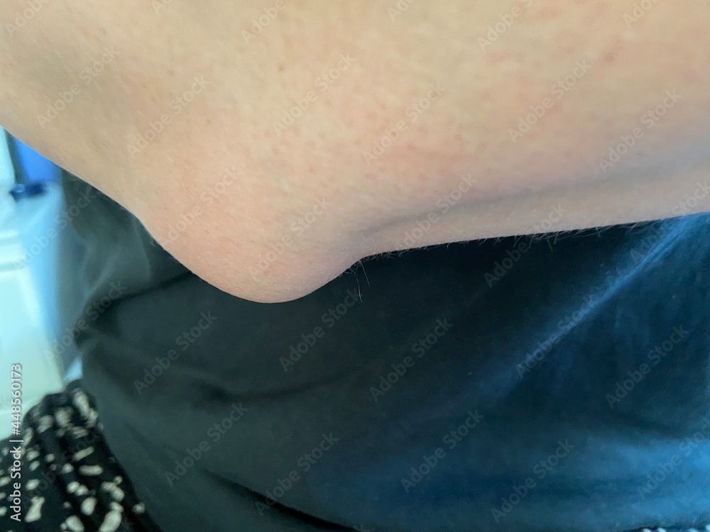 Fotografie olecranon bursitis is sometimes called “Popeye’s elbow ...