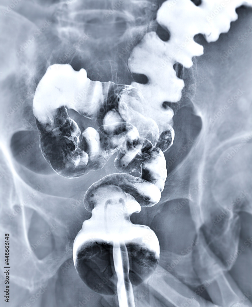 barium enema demonstrated l rectum and colon for diagnosis Colorectal ...