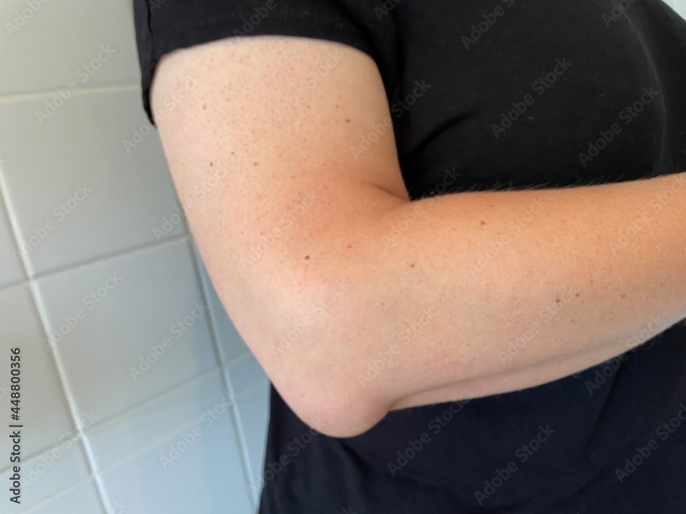 Fotografie olecranon bursitis is sometimes called “Popeye’s elbow ...