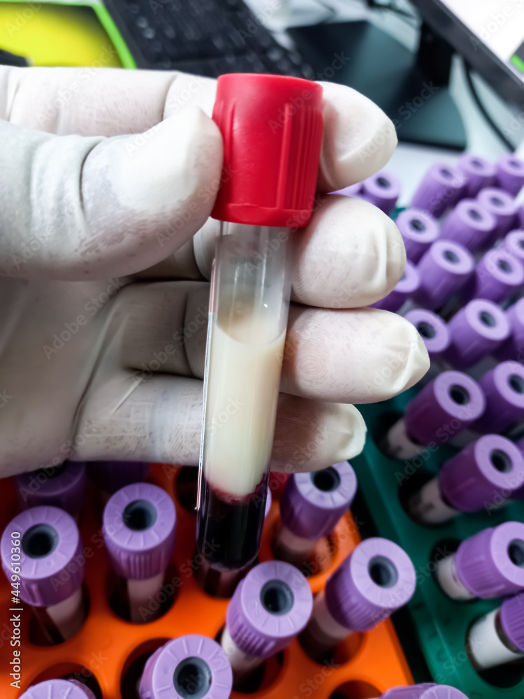 Scientist or Biochemist hold Lipemic blood sample. High Triglyceride ...