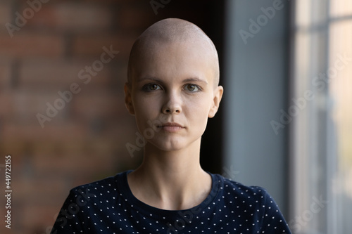 Young hairless cancer survivor head shot portrait, patient profile ...