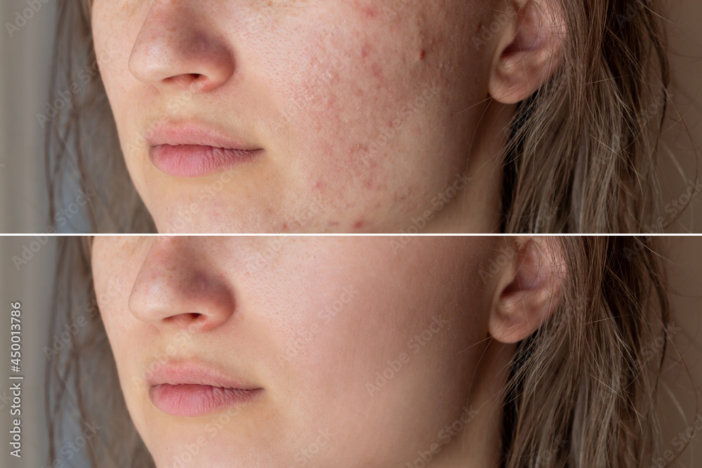 Cropped shot of a young woman's face before and after acne treatment on ...