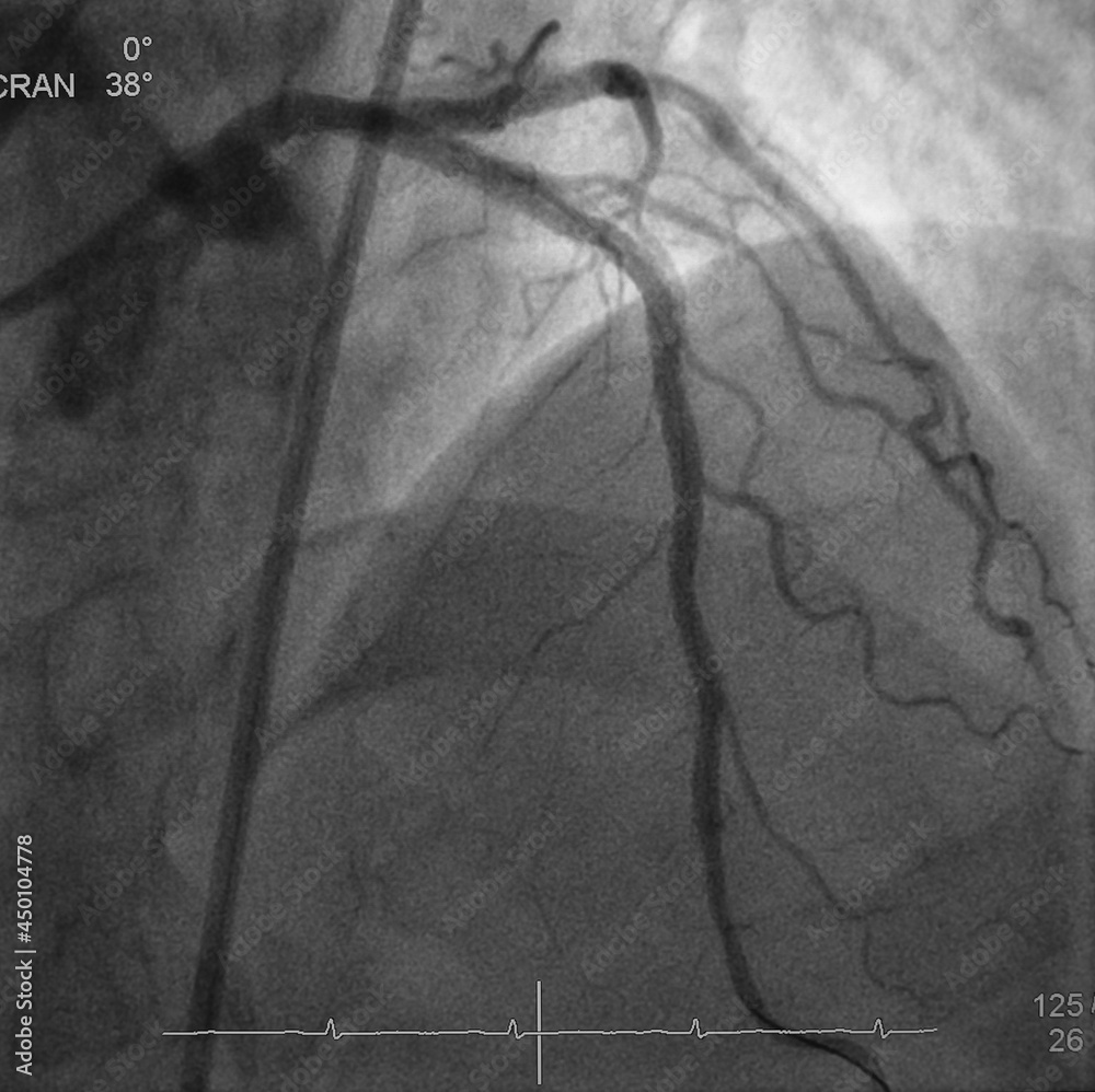 coronary angiogram (CAG) was performed post percutaneous coronary ...