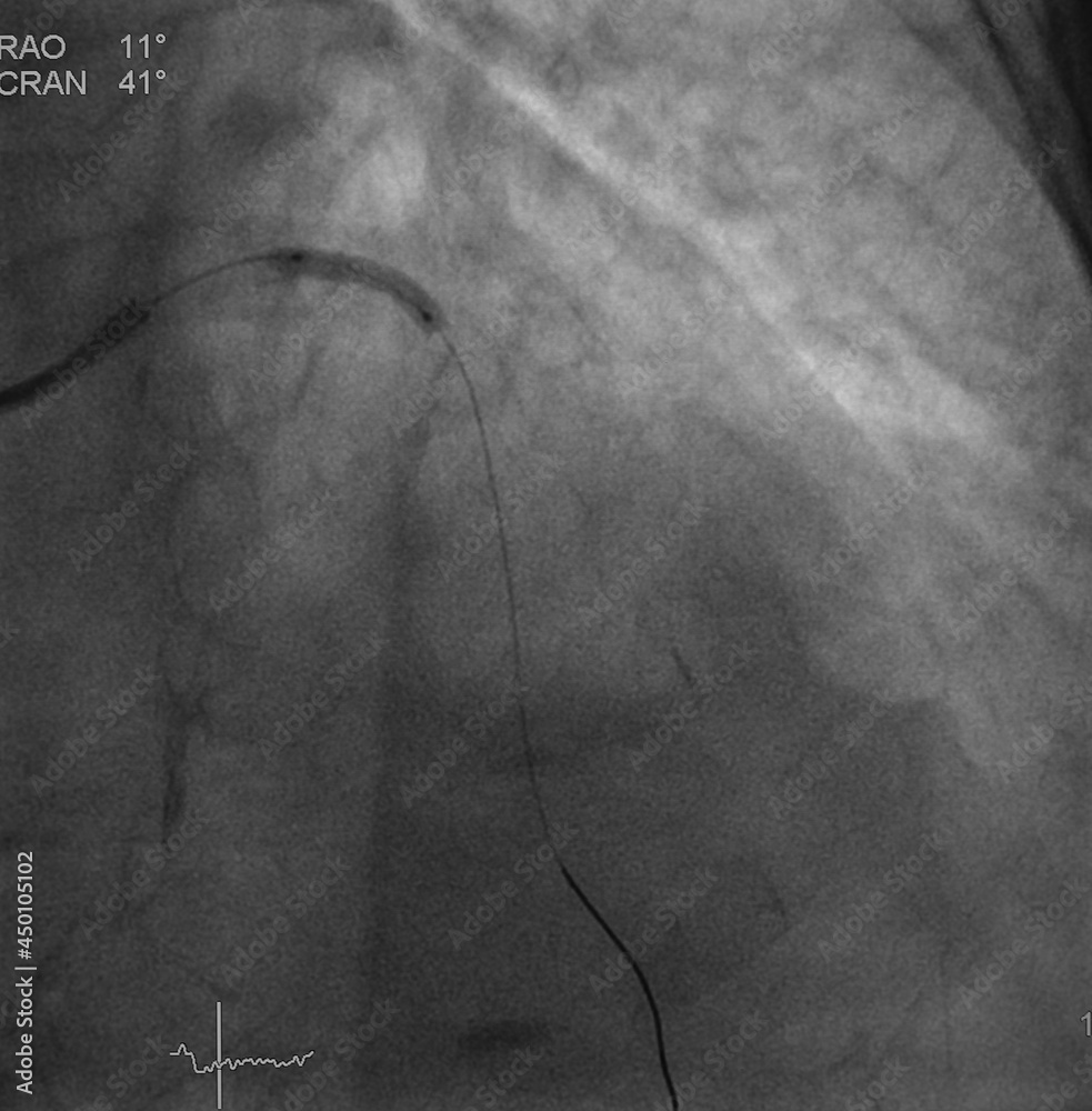 x ray image perform balloon catheter inflation at left coronary artery ...