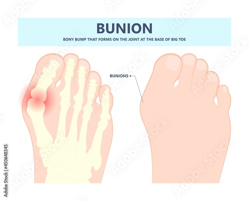 bony bump joint big toe bone enlarge fifth foot pain shoe Tailor ...