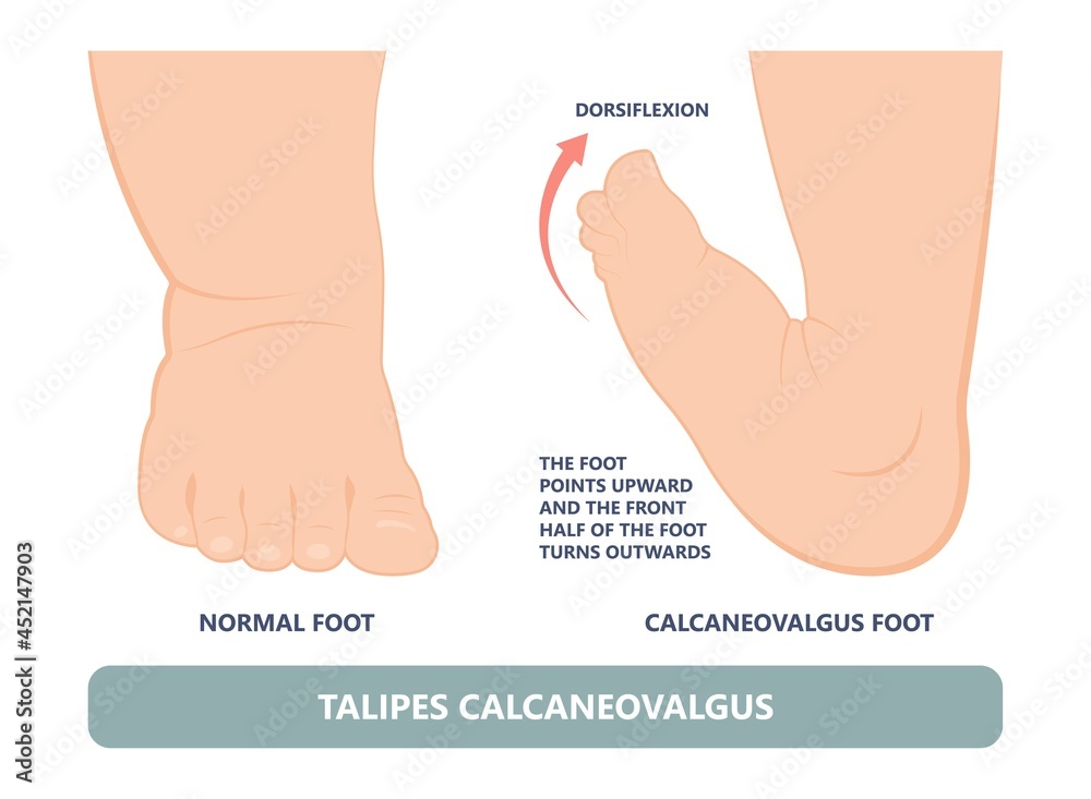 foot deformities infant turned inward upward birth baby tendon leg ...