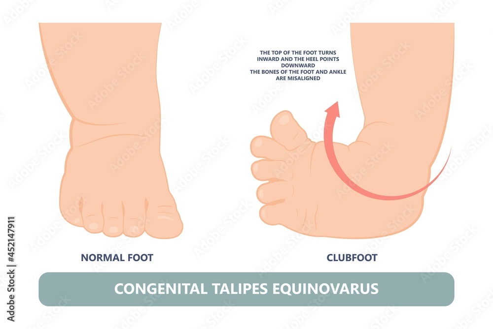 foot deformities infant turned inward upward birth baby tendon leg ...