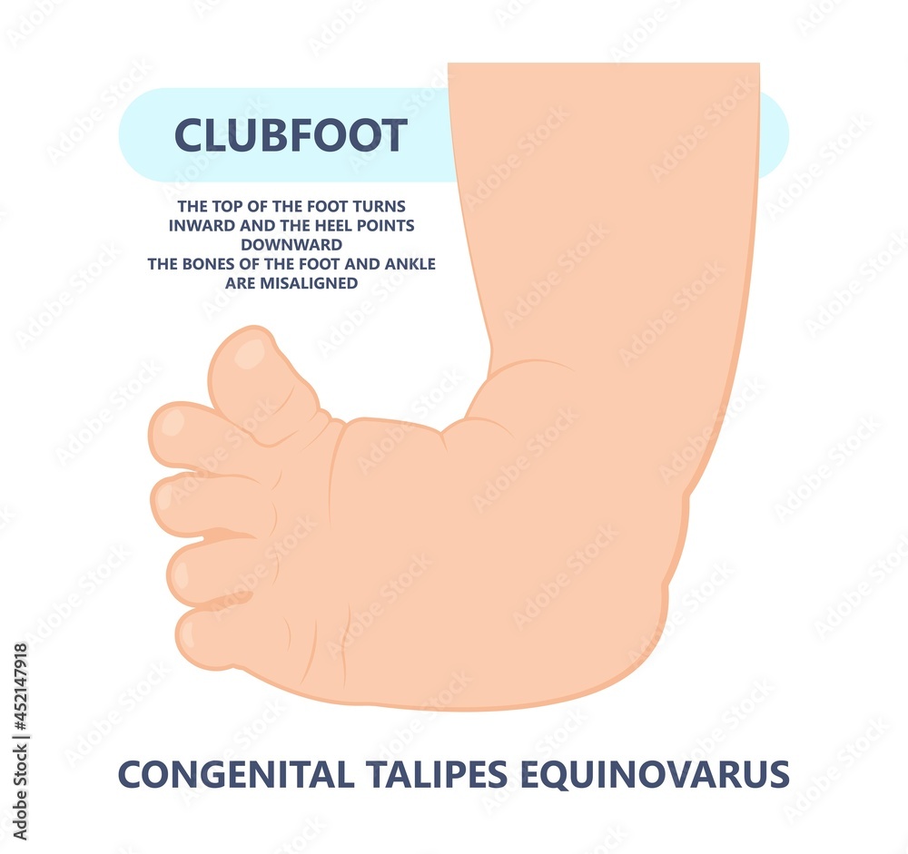 foot deformities infant turned inward upward birth baby tendon leg ...