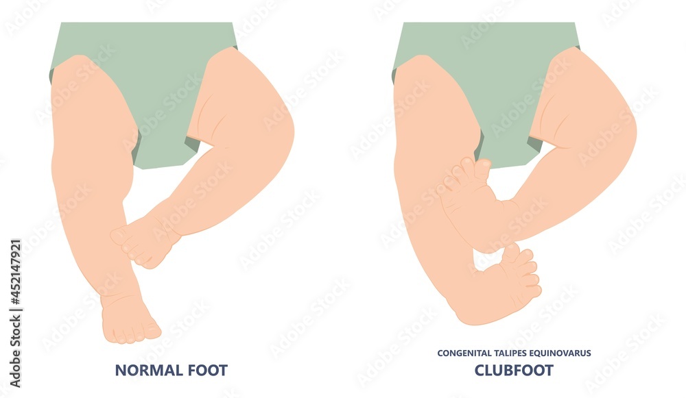 เวกเตอร์ Stock foot deformities infant turned inward upward birth baby ...