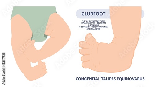 foot deformities infant turned inward upward birth baby tendon leg ...
