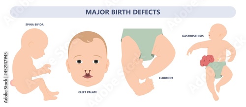 foot deformities infant turned inward upward birth baby tendon leg ...