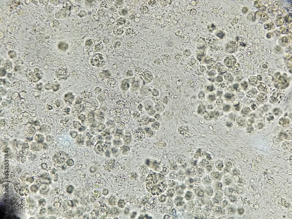 Urine sediment microscopic show plenty of pus cells or white blood cell ...