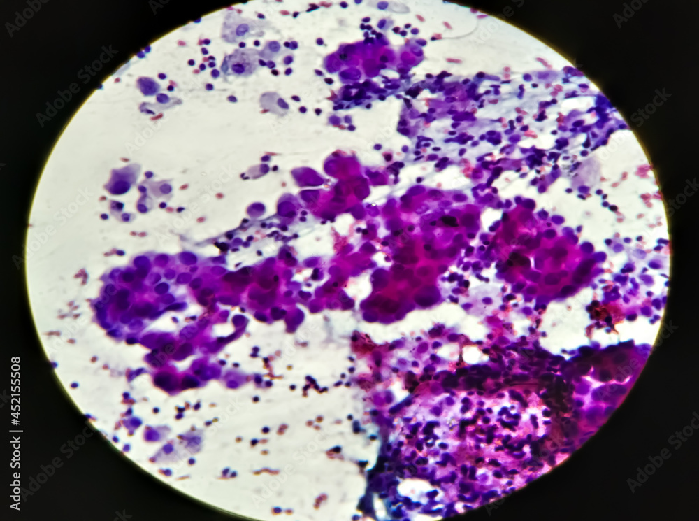 Liver SOL (CT guided FNA) microscopic 100x show positive for malignant ...