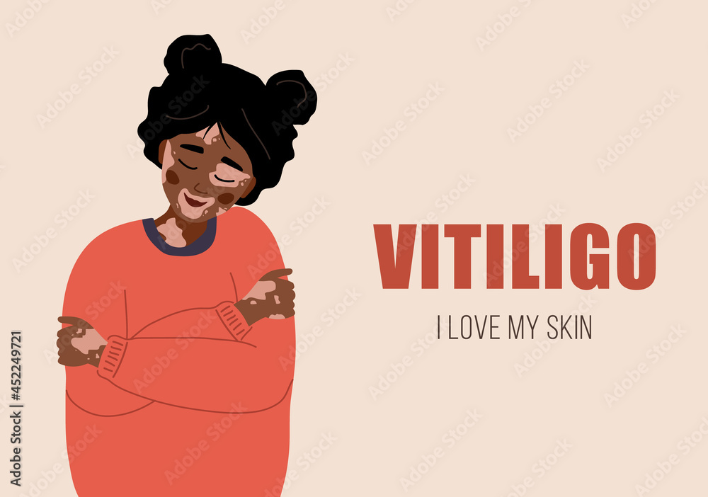 African woman with vitiligo. Self care and self love. World vitiligo ...