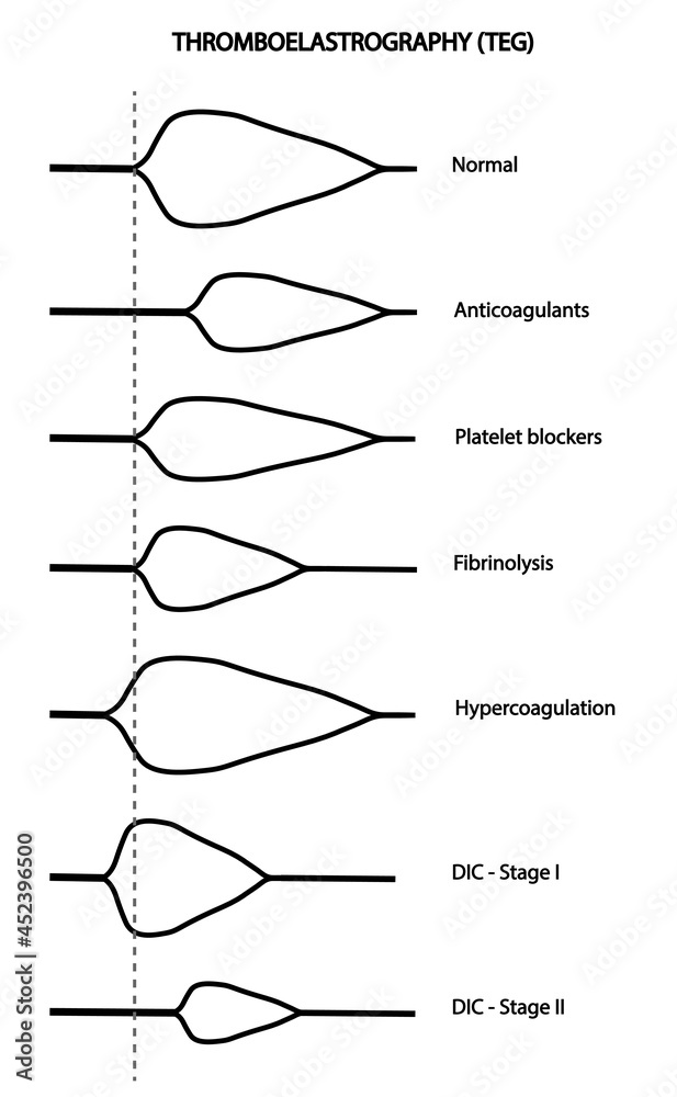 Thromboelastography (TEG). Blood coagulation analysis types. Different ...