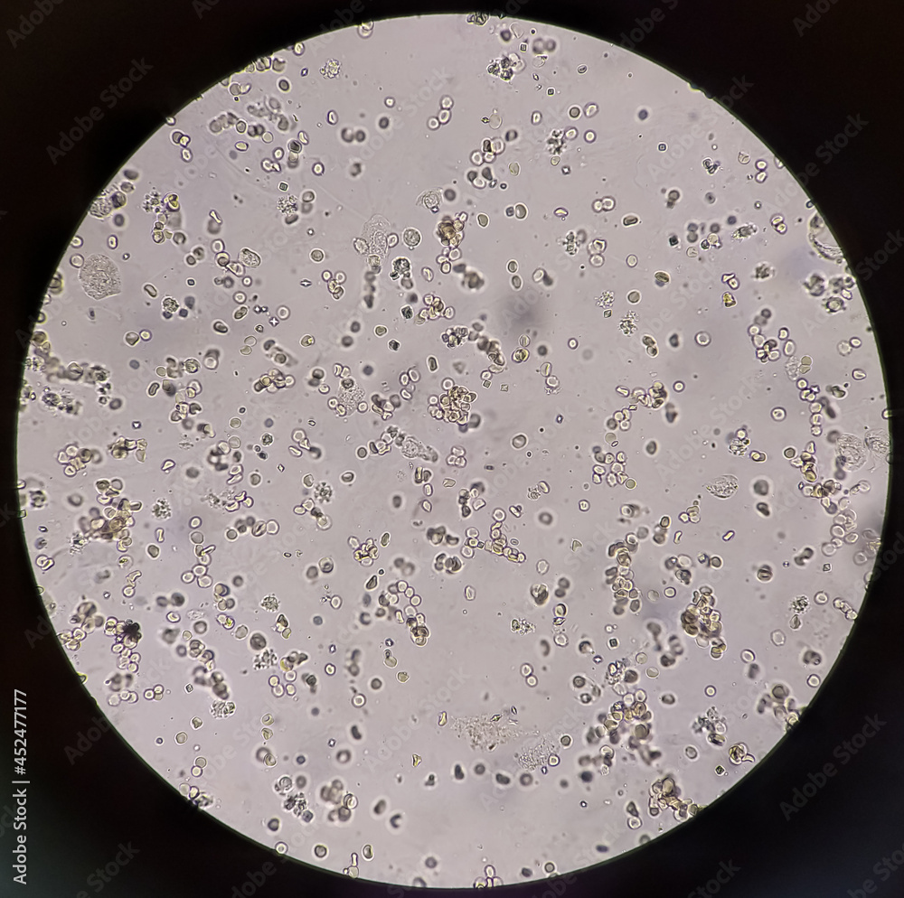 Microscopic view of urine RBC is called hematuria, serious causes of ...