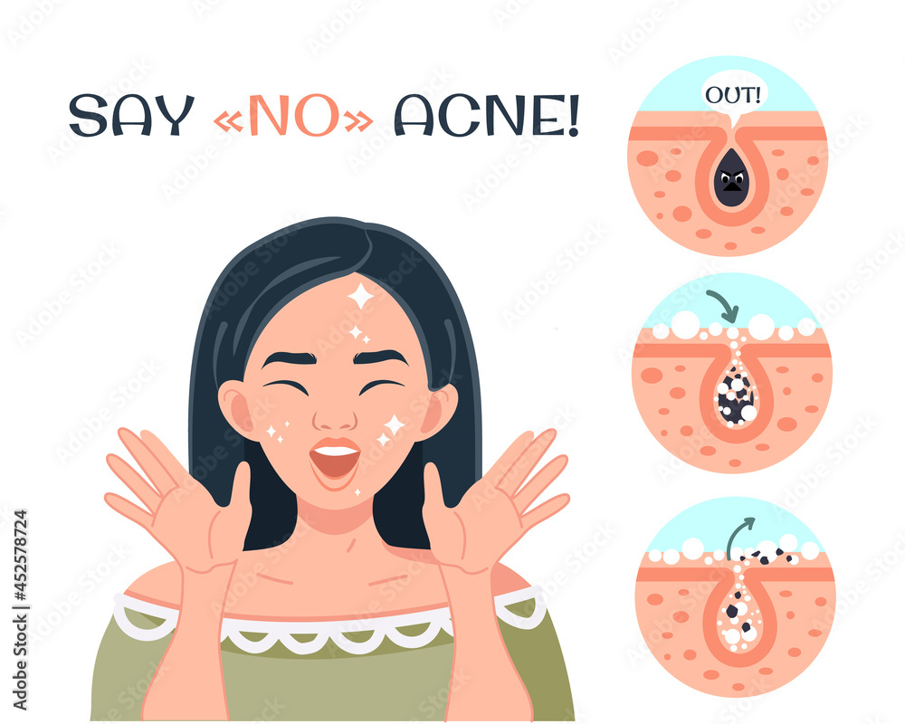 Vector poster "Say no to acne!" A young Korean girl with perfect skin ...