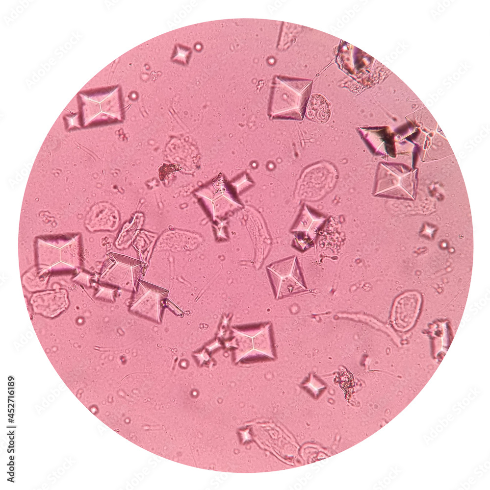 Urine sediment showing Struvite crystals, spermatozoa, RBC and squamous ...