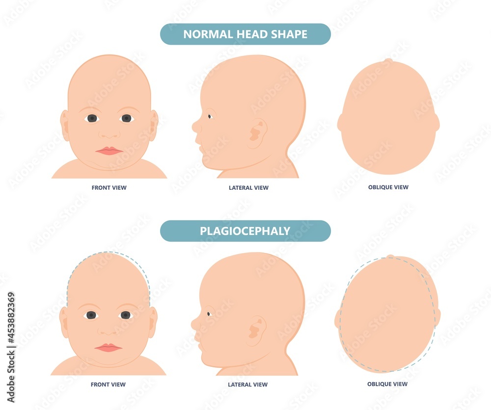 Vector de Stock craniosynostosis helmet pillow flat head autism brain ...