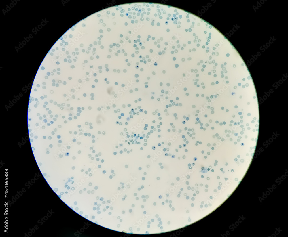 Reticulocyte count under microscope, 100x. methylene blue staining ...