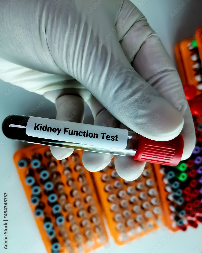 Blood samples for renal function test (Creatinine, BUN, Uric acid ...