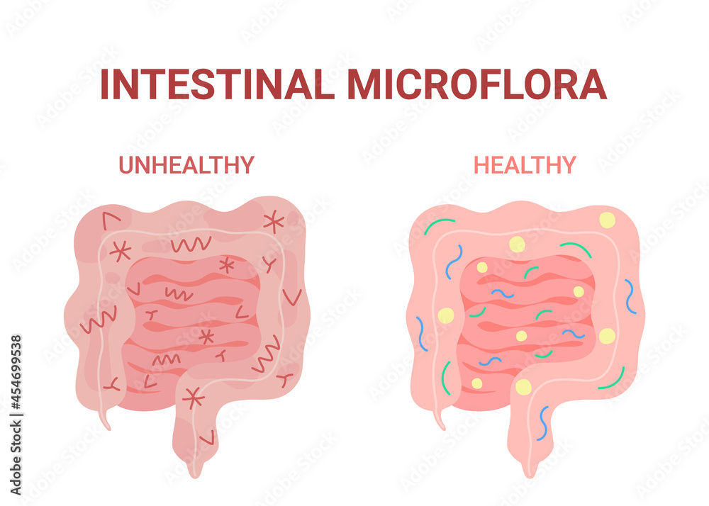 Healthy and unhealthy microflora intestinal, good and bad nutrition gut ...