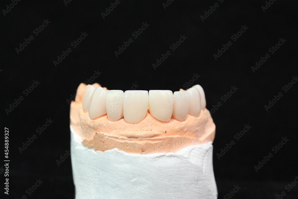 Dental crowns in the plaster model for treatment and new smile Stock ...